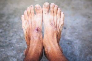Vancouver Podiatrist’s Guide to Effective Foot Wound Care - Clover ...
